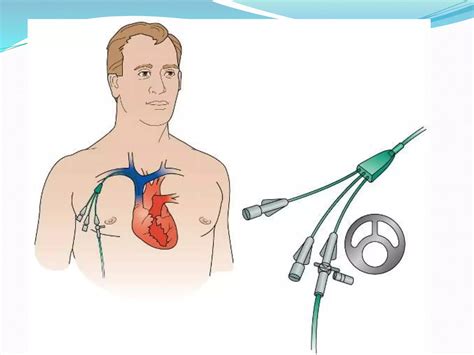 Central Venous Access Catheter Artofit
