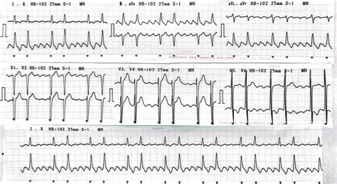 Ecg Ladder Diagrams Atrial Flutter With Variable Block