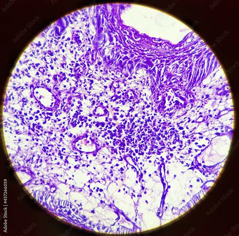 Cancer Of Esophagus Poorly Differentiated Adenocarcinoma In A Patient Tumor Cells Undermine