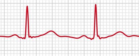 Prolonged Qt For Years R Longqtsyndrome