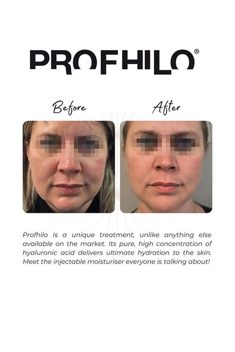 Profhilo The Injectable Moisturiser Everyone Is Talking About