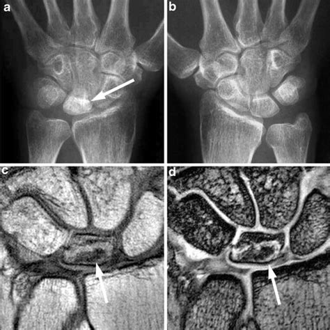 Kienböcks Disease Radiographs Of A The Affected Side Arrow And B