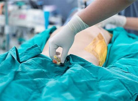 Summary Of Impact Of Low Pressure Pneumoperitoneum On Post Operative