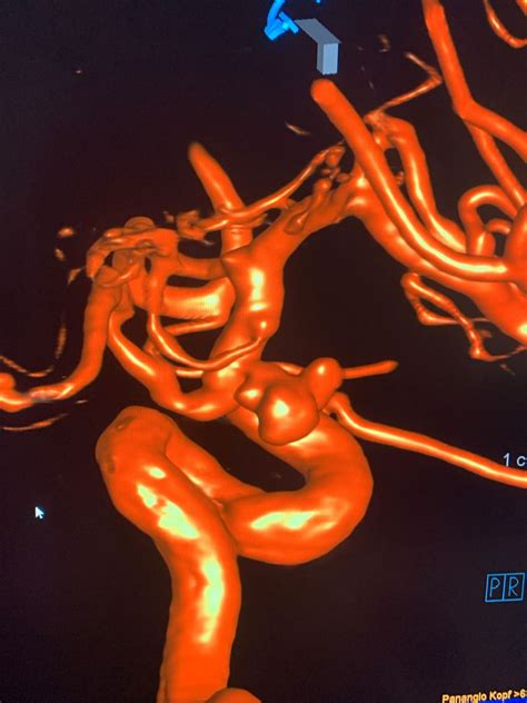 Zakarya Ali On Linkedin 53 Years Old Woman With Ruptured Pcom Aneurysm
