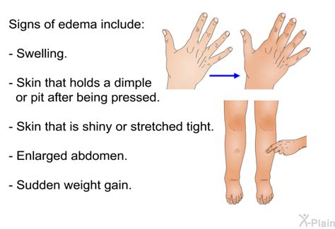 Edema