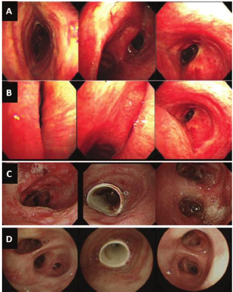 Normal Bronchoscopy Epos™