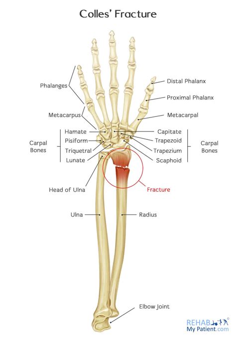 Colles Fracture Rehab My Patient