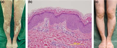 Case Of Erythrokeratodermia Variabilis Successfully Treated With
