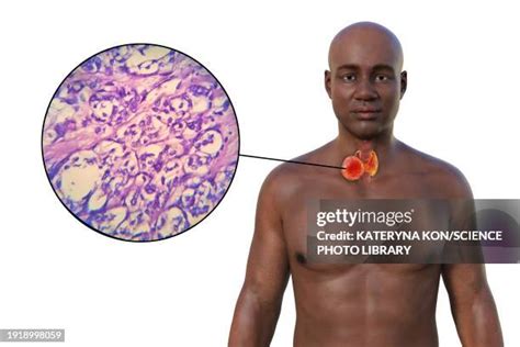 Thyroid Micrograph Photos And Premium High Res Pictures Getty Images