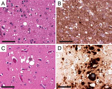 1 Histologic Features Of Prion Diseases Central Nervous System