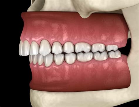 4 Types Of Malocclusion Fixed By Invisalign Laurich Dentistry