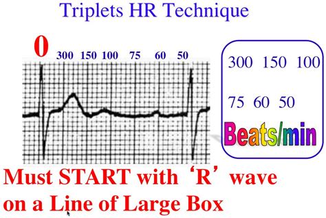 Triplets R To R Second Heart Rate Method