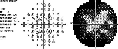 Cloverleaf Visual Field American Academy Of Ophthalmology