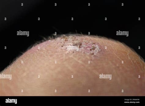 A Photo Of A Scab On The Knee Of Someone Stock Photo Alamy