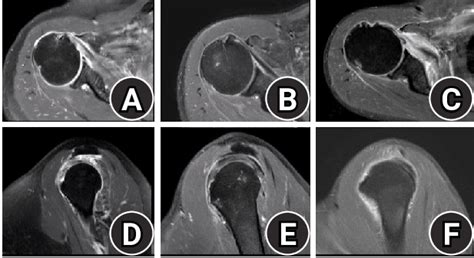 Evaluation Of Subscapularis Tendon Tear Using Magnetic Resonance Download Scientific Diagram