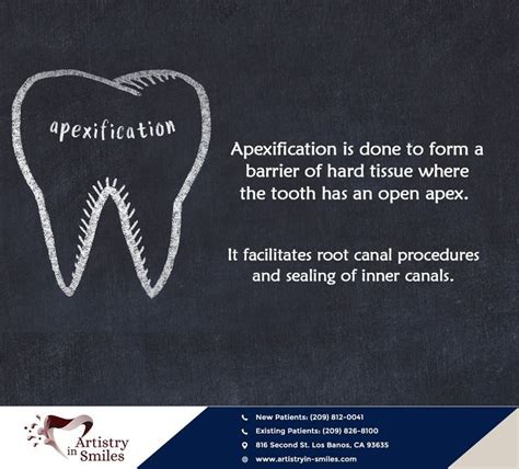 Apexification Enables The Proper Sealing Of The Tooth After Rootcanal