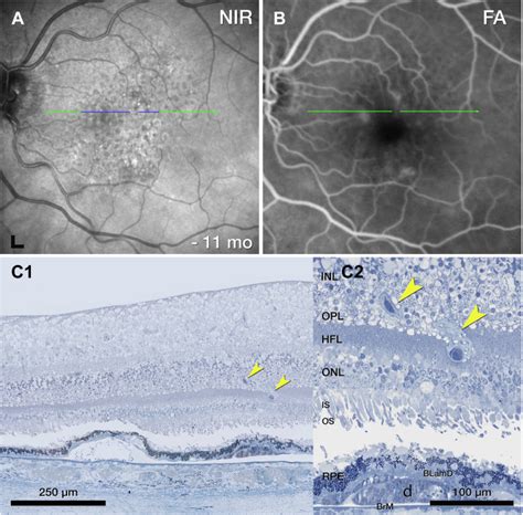 Histology Of Type 3 Macular Neovascularization And Microvascular Anomalies In Treated Age