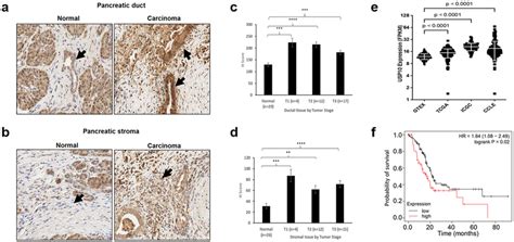 Expression And Significance Of Usp10 In Pancreatic Cancer A D