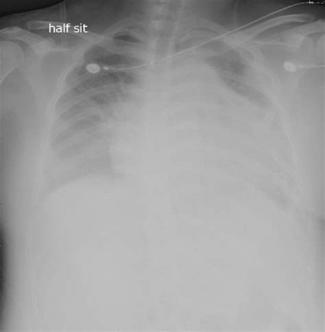 Postoperative Chest X Ray From The Icu Download Scientific Diagram