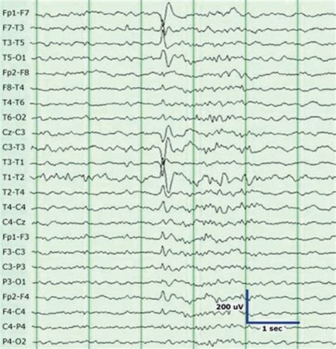 Sharp Waves In The Left Temporal Region Are Seen In A Patient With Left Download Scientific