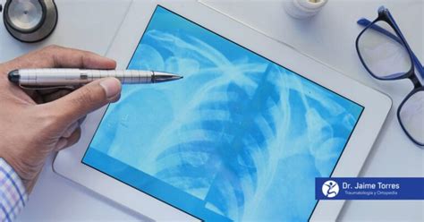 Fractura De Hombro Tipos Y Tratamiento Dr Trejo