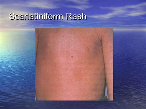 Pharyngitis Ppt