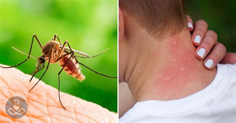 Mosquito Bites Sting And Swell You Could Have Skeeter Syndrome