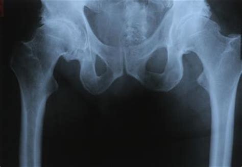 Interpreting And Improving Hip Internal Rotation Miguel Aragoncillo