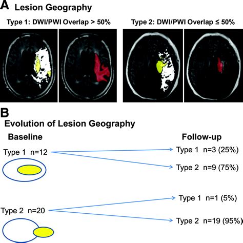 Geography Structure And Evolution Of Diffusion And Perfusion Lesions In Diffusion And