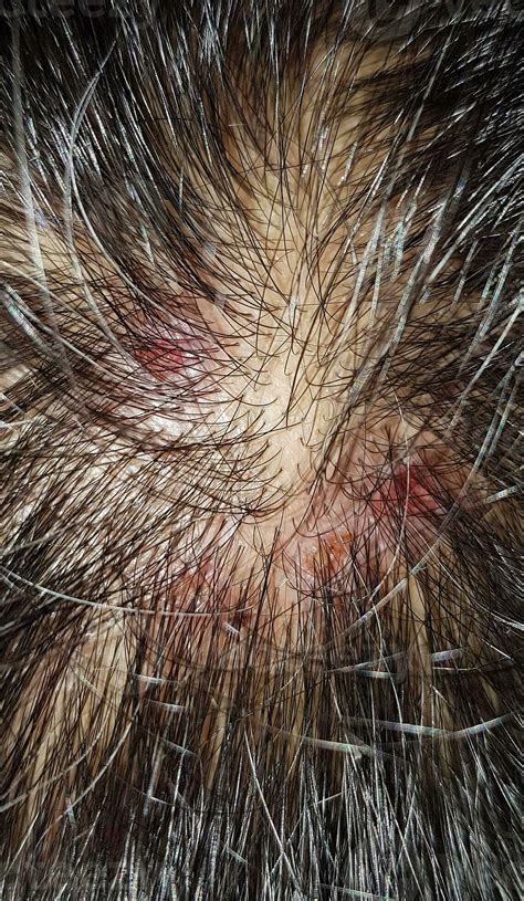 Scabs On The Scalp Wound On The Scalps Or Lichen Planus Follicularis