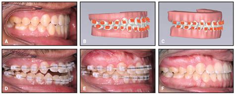 Efficacy Of Custom 3d Printed Lightforce Brackets