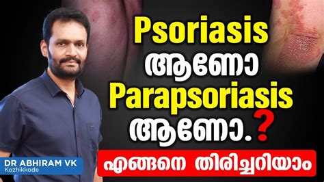 Parapsoriasis Treatment