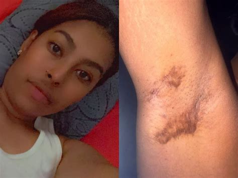 전신 제모 후 겨드랑이 혹 전신으로 퍼져” 美 29세 여성 뒤늦게 ‘이 질환 진단