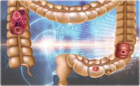 Diverticulitis Colonoscopy