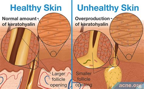 Hyperkeratinization Acne