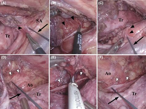 Dissection Of Recurrent Laryngeal Nerve Lymph Node A The Right Rln