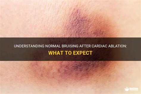 Understanding Normal Bruising After Cardiac Ablation What To Expect
