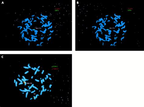 Mosaicism For Duplication 12q 12q13→12q21 2 Accompanied By A