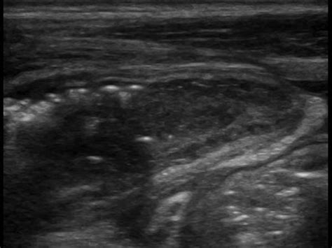 Abdomen And Retroperitoneum 15 Appendix Case 153 Complicated