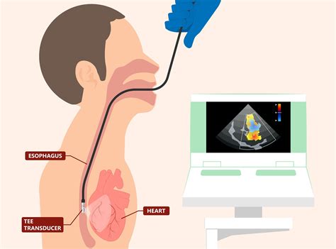 What Is A Transesophageal Echocardiogram Test