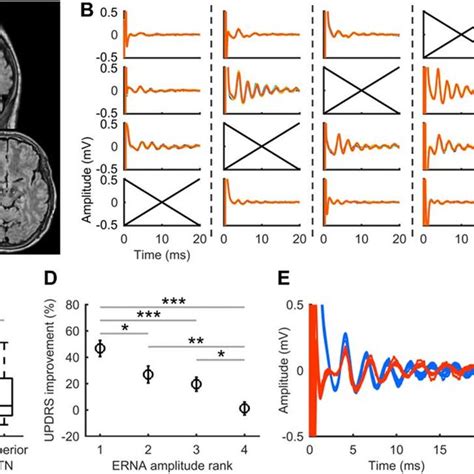 Evoked Resonant Neural Activity Erna Positional Variation Clinical Download Scientific