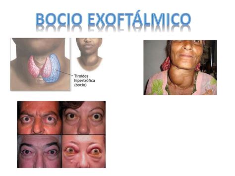 Ppt Trastornos Hormonales Powerpoint Presentation Free Download Id