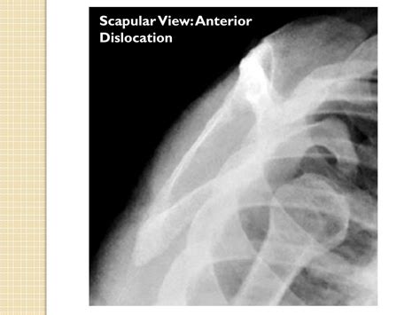 Ppt Radiography Of The Shoulder Powerpoint Presentation Free Download Id 3000947