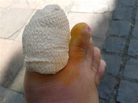 Somewhere In Singapore Blog Swollen Toe Th Mar