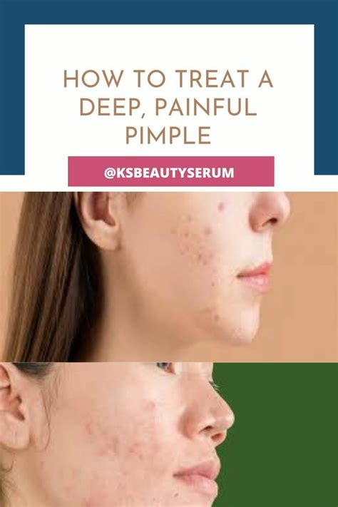 How To Treat A Deep Painful Pimple Artofit