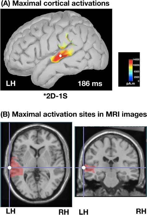 Sources Of Mismatch Components A Maximal Cortical Activities In The Download Scientific