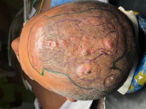 Scalp Angiosarcoma A Case Report Asian Journal Of Plastic And