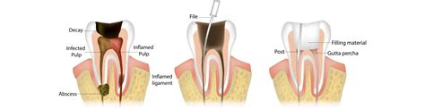 Failed Root Canal Symptoms Causes And Treatment — Chevy Chase Dental Care