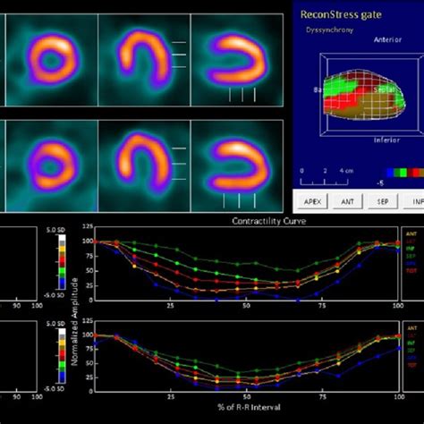 Gated Spect Images Demonstrating The Normal Perfusion Pattern Upper