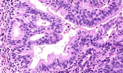 Pathology Outlines Progestin Therapy Related Changes
